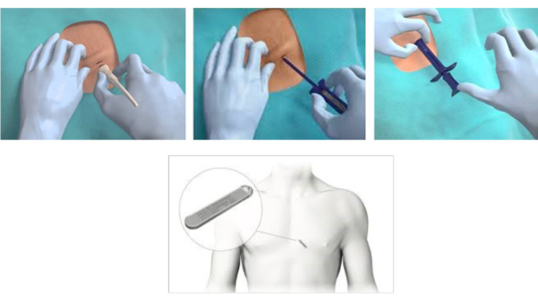Holter sous cutané implantable