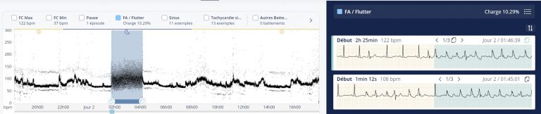 Holter rythmique (ou Holter ECG) | Rythmo